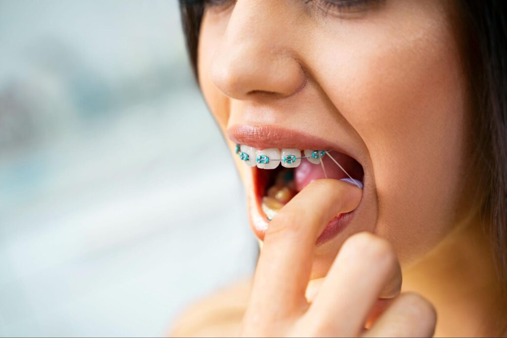 Everything You Need to Know About Wearing Elastics With Braces | Dr ...
